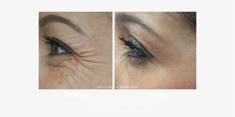 Botox Eye Wrinkles - Botox Before And After Under Eye Wrinkles ...