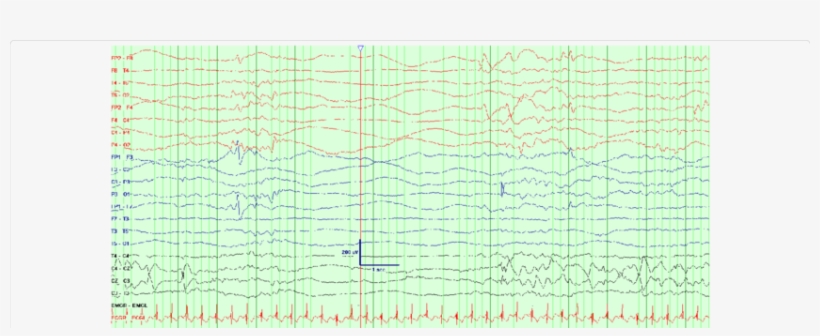 Eeg Background Showing Burst Suppression Pattern - Burst Suppression ...