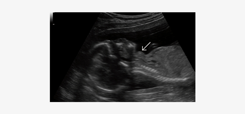 Fetal Goiter - Fetal Goiter Ultrasound Transparent PNG - 618x300 - Free ...