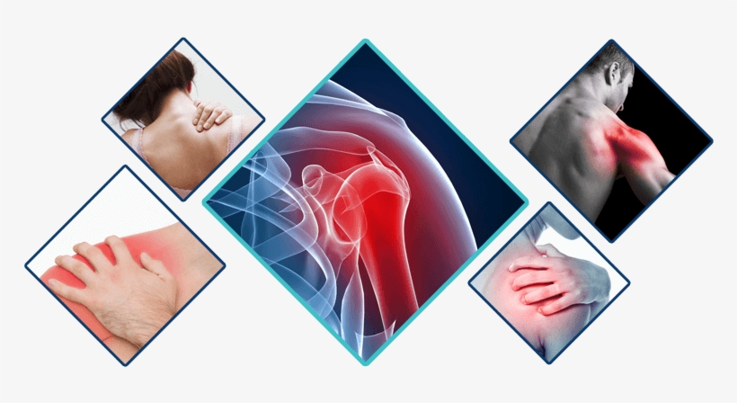 Interactive Body Shoulder Pain - Polymyalgia Rheumatica And Giant Cell ...