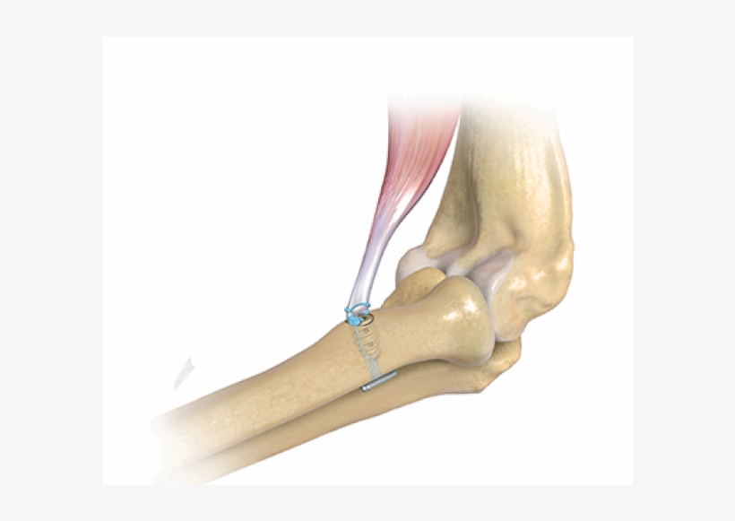 Distal Biceps Repair The Biceps Button And Tension-slide - Biceps ...