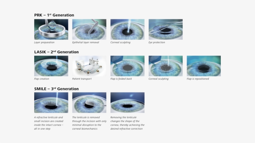 Laser Vision Correction Techniques - Prk Vs Lasik Vs Smile Transparent ...