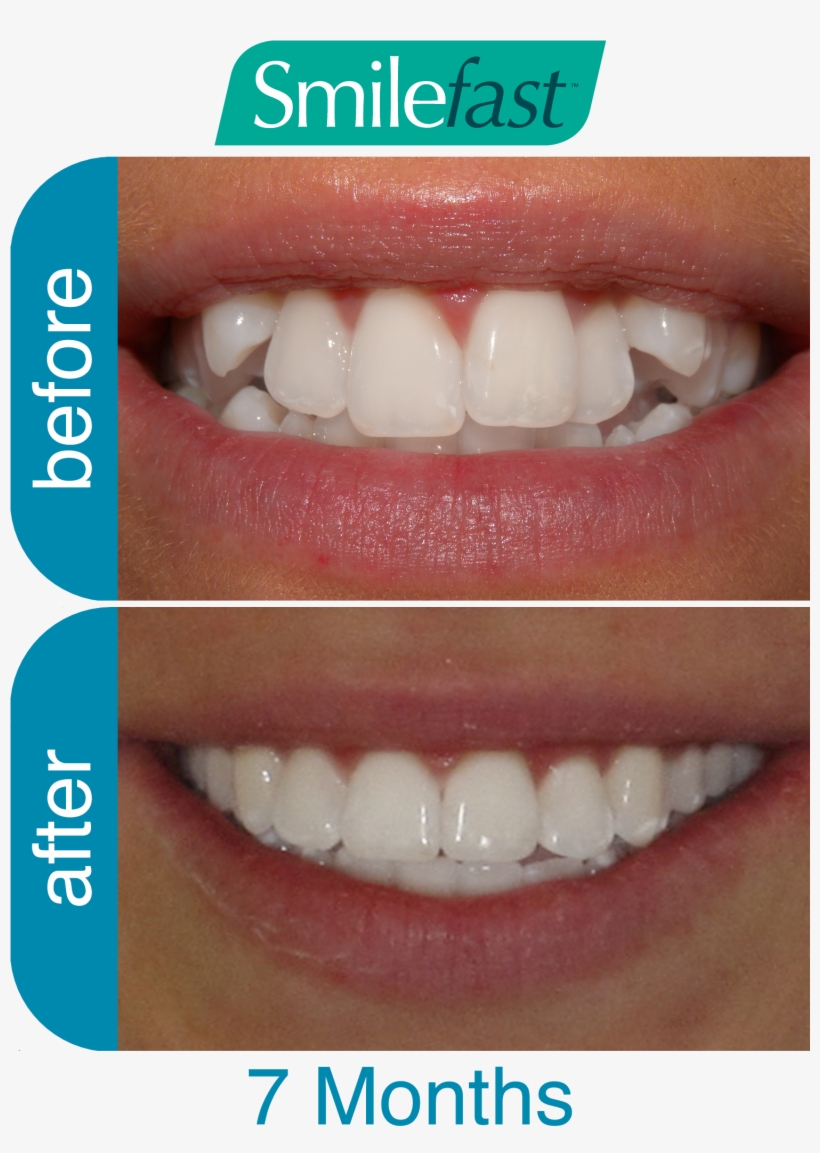 Aqd Smilefast After 7-months - Smilefast Before And After Transparent ...