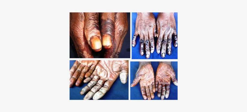 Burning Skin And Detachments From Contacts With Cashew - Cashew Nut ...