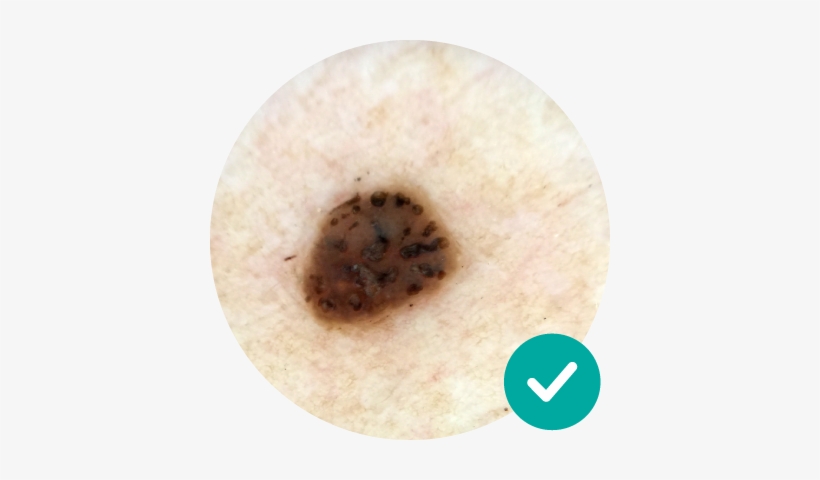 Mole Both Borders - Mole With Little Black Dots Transparent PNG ...