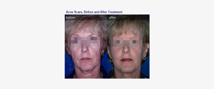 Photo Of Before & After Acne Scaring - Deep Rolling Acne Scars Chin ...