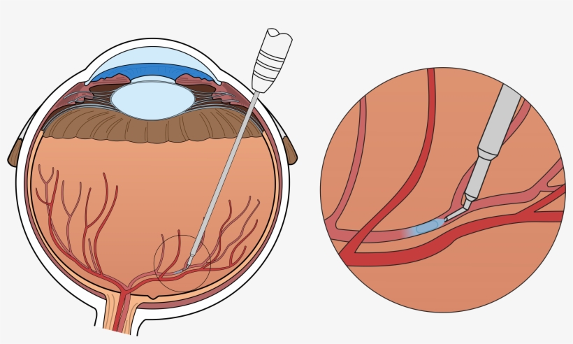 At The Moment, Treatment Consists Of Monthly Injections - Robot Assist ...