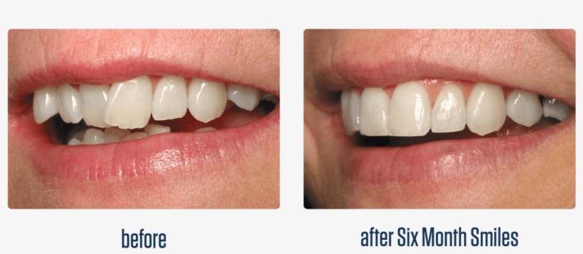 Clear Bracket Braces Before And After Transparent PNG - 1650x715 - Free ...