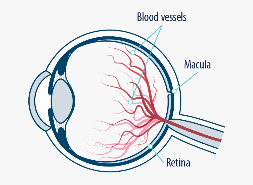 Eye Blood Vessels, Macula, And Retina - Retinal Vein Occlusion Cartoon ...