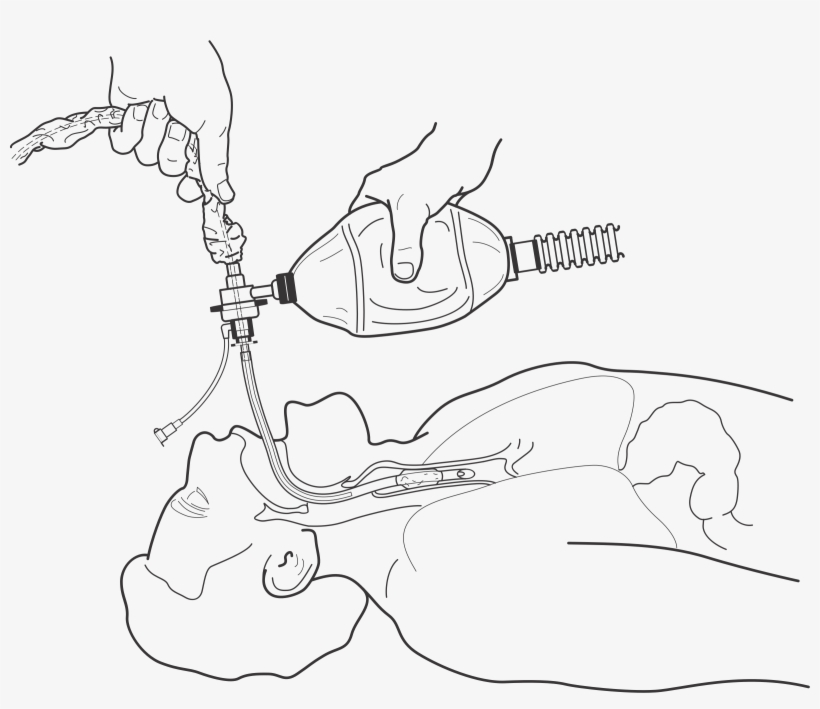 Download This Free Icons Png Design Of Endotracheal Procedure - HD ...