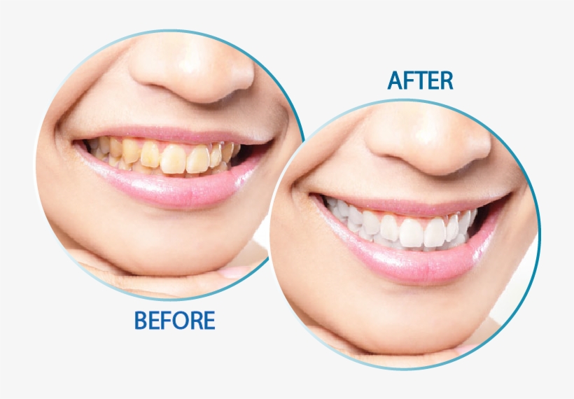 Teeth Whitening - Peridex Stain Transparent PNG - 735x490 - Free ...
