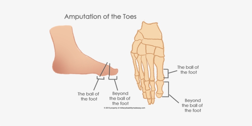 The Amputation Of The Toes 6 - Hallux Amputation Transparent PNG ...