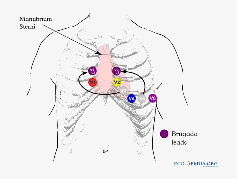 Brugada Lead Placement - Brugada Syndrome Ecg Placement Transparent PNG ...