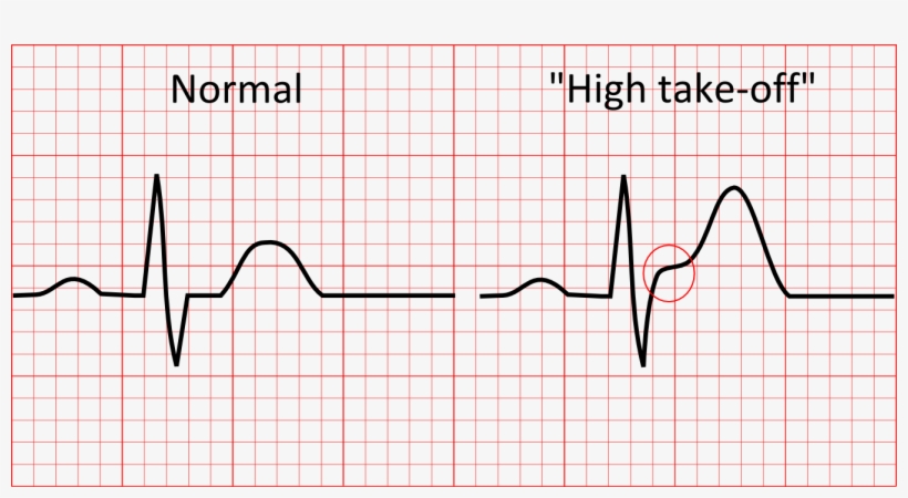 This Normal Variant Of The Ecg Represents Early Repolarisation - Normal ...
