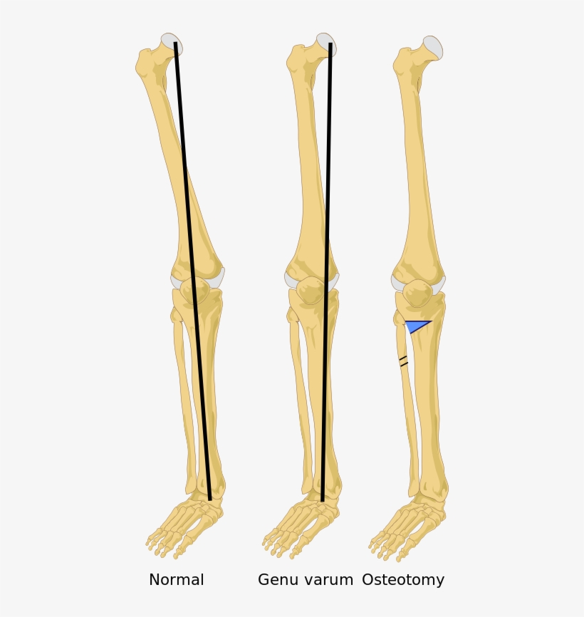The Black Line Is The Mechanical Axis - Genu Varum Transparent PNG ...