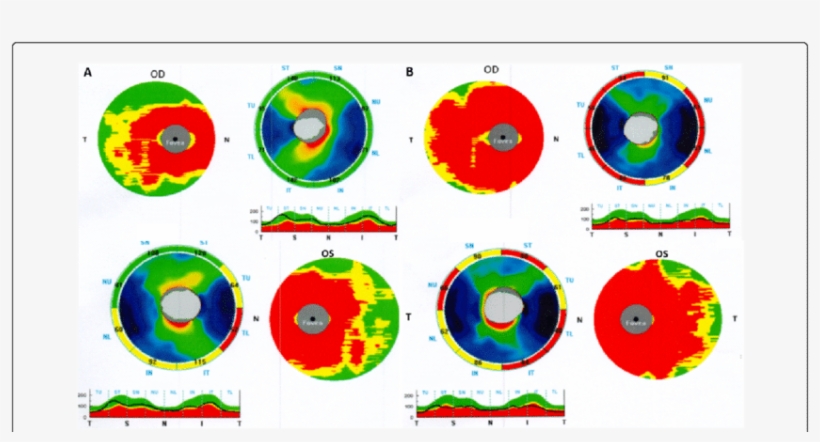 Optic Coherence Tomography Transparent PNG - 850x417 - Free Download on ...