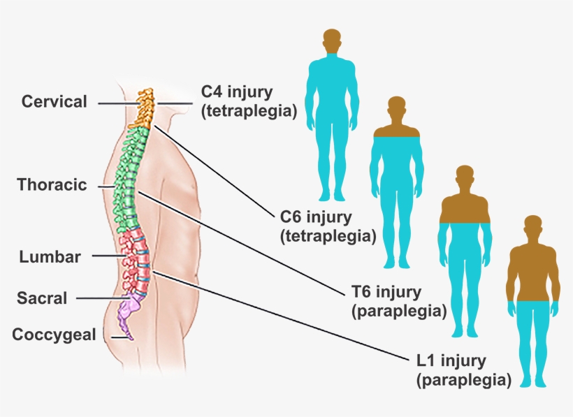What Is Spinal Cord Injury - C7 Spinal Cord Injury Transparent PNG ...