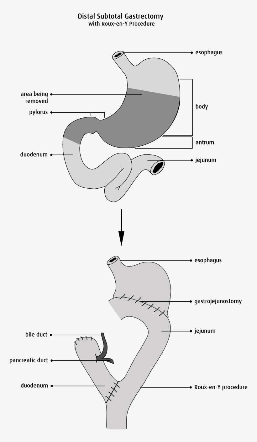 Distal Gastrectomy