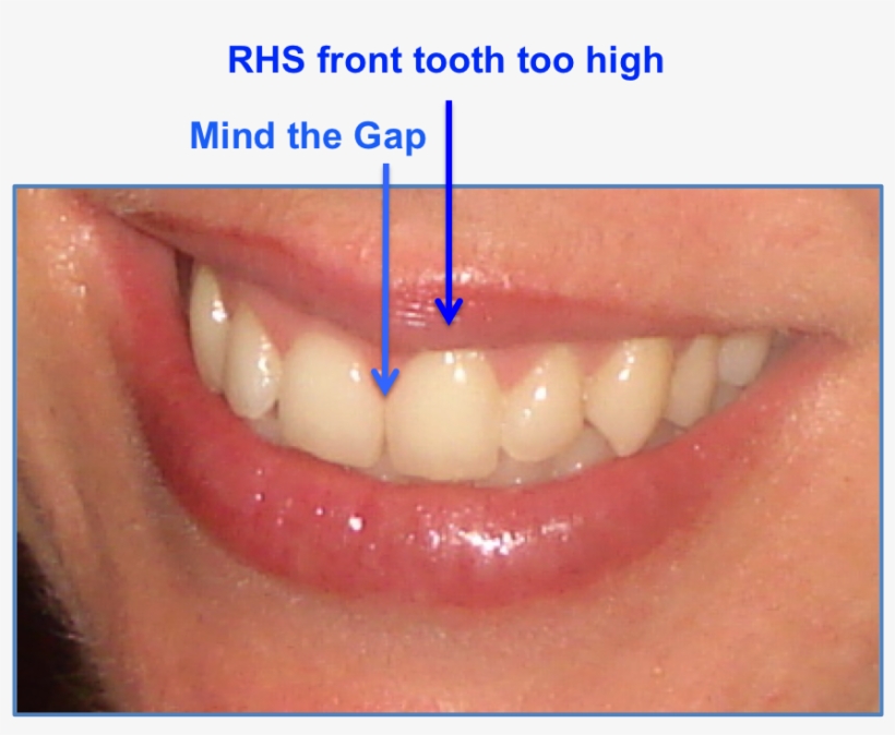 Invisalign Growingonup How To Make Your Teeth Whiter - Mild Buck Teeth ...