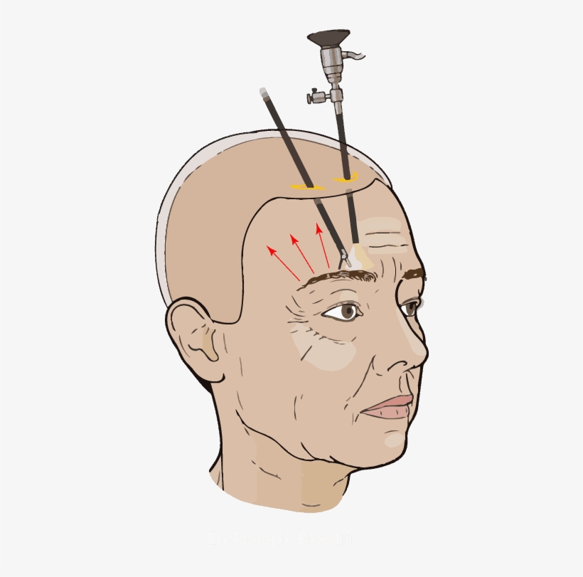 Diagram Of Endoscopic Brow Lift To Raise The Forehead - Illustration ...