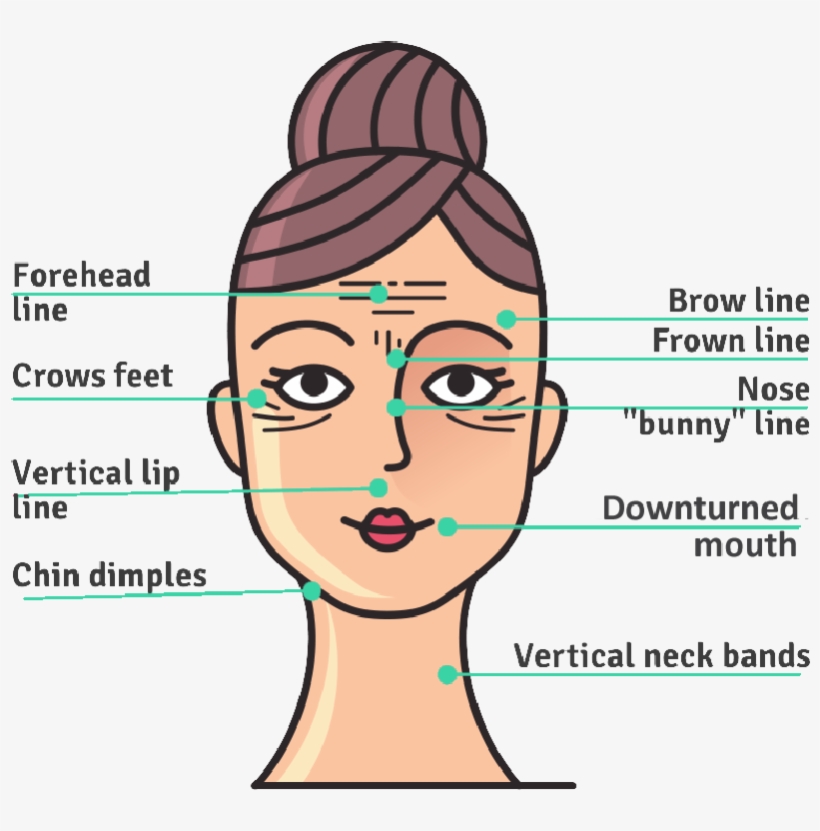 Botox Injection Sites Forehead, Brow, Forwn, Crows, - Cartoon ...