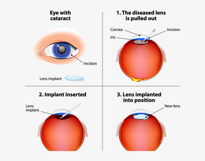 Cataracts Are One Of The Main Causes Of Blindness And - Cataract ...