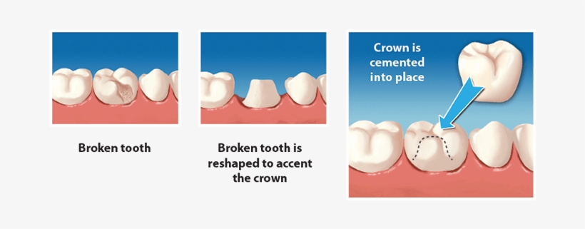 Crowns - Crown Placement On Tooth Transparent PNG - 700x255 - Free ...
