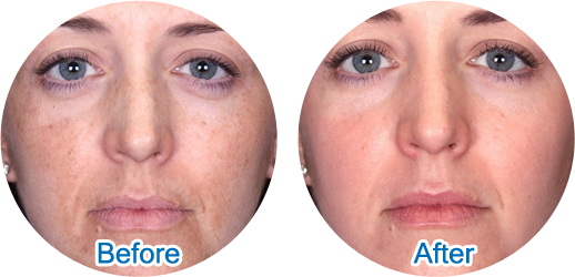 Download Cells Of Skin & Improve The Skin Texture - Chemical Peel Anti ...