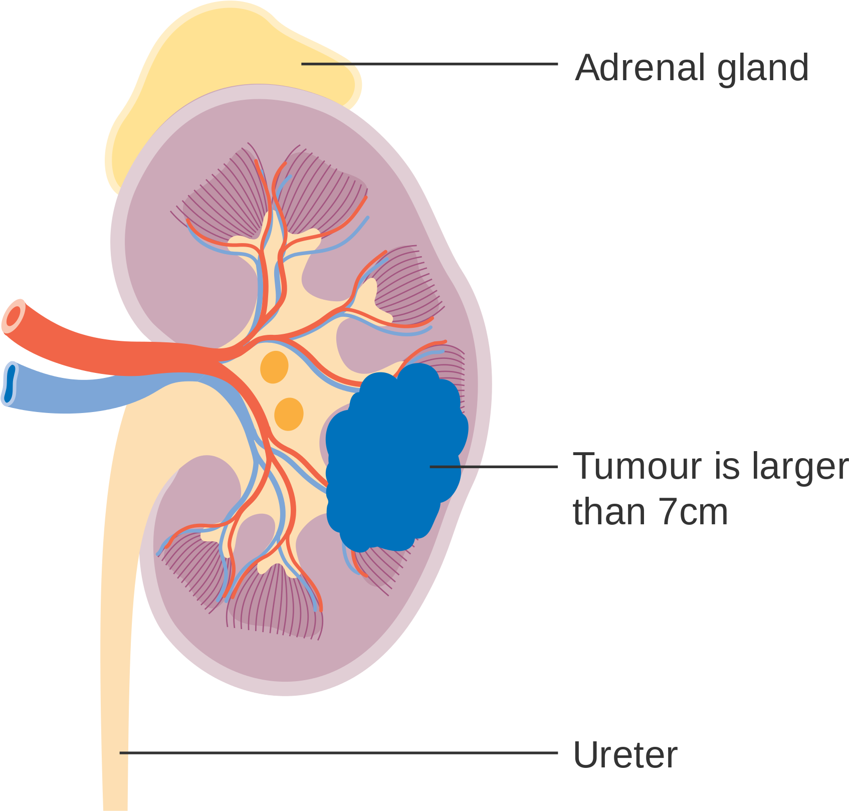 Download HD Open - Kidney Cancer Diagram Transparent PNG Image ...