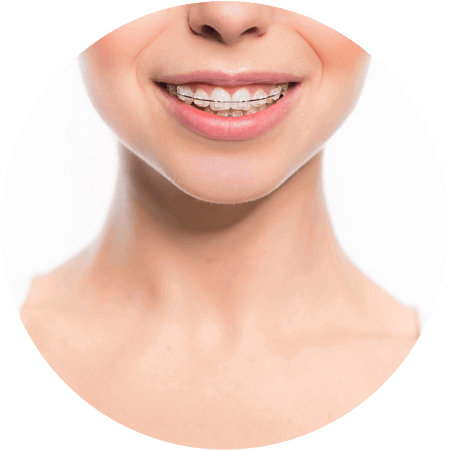 Download HD Clear Braces - Dental Braces Transparent PNG Image ...