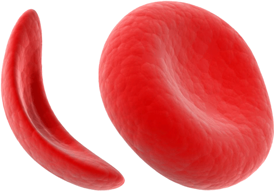 Download HD What Is Sickle Cell Disease - Sickle Cell Anemia ...