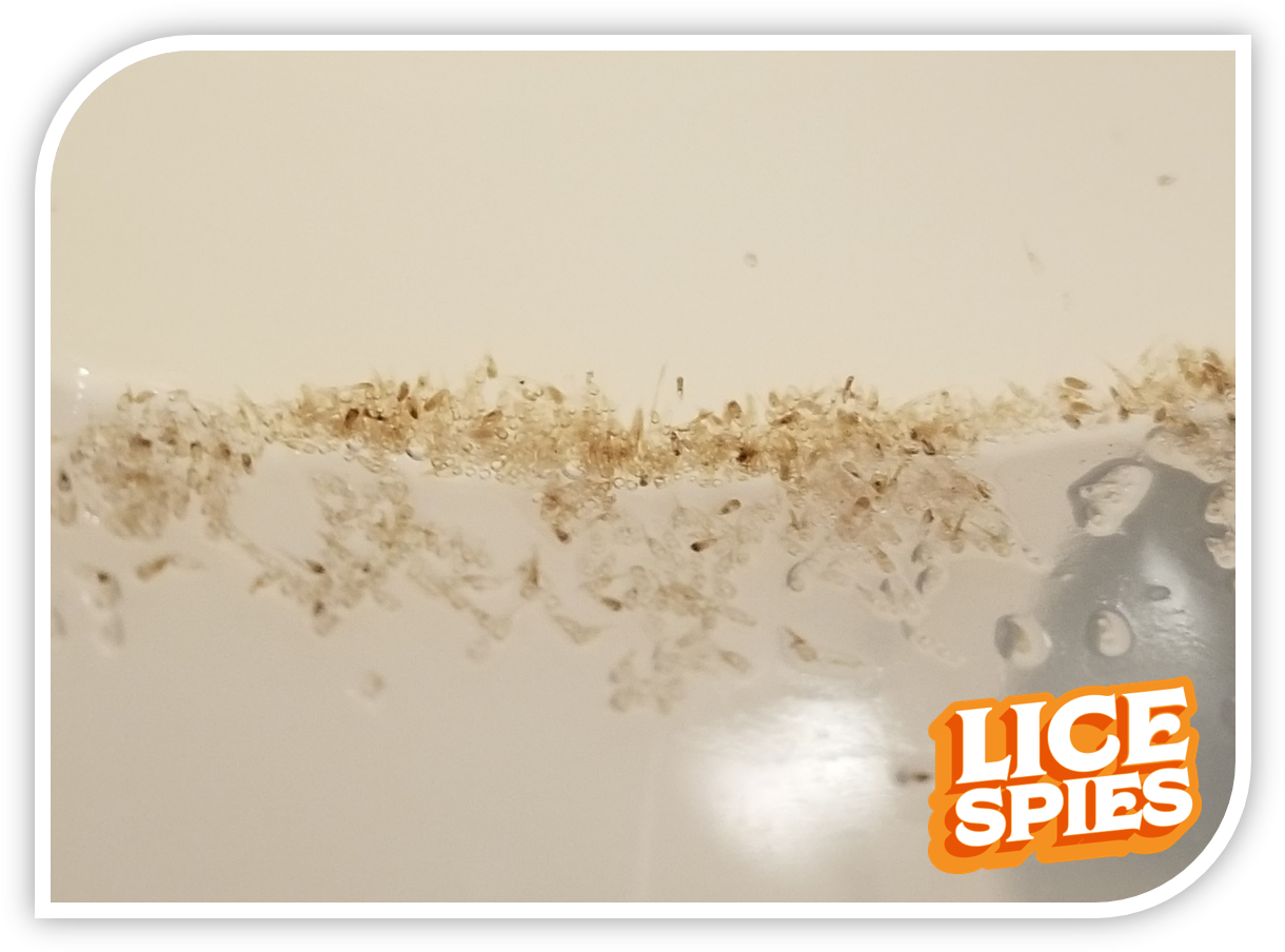 Download HD Lice Spies 6 Month Battle Png - Head Lice 2018 Transparent ...
