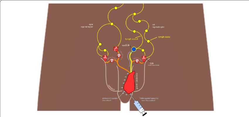 Download Schematic Representation Of Inguinal Lymphatic Drainage ...