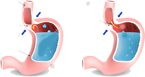 Download Gasteroesophageal Reflux Disease - Gerd Symptoms - HD ...