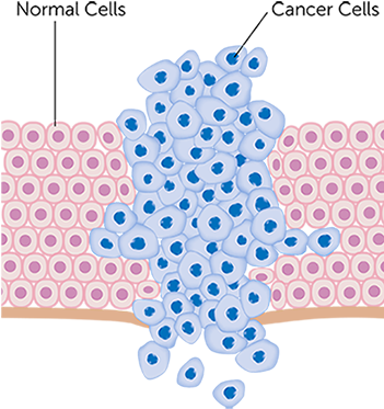 Download Cancer Basics - “ - Crecimiento De Celulas Cancerosas - HD ...