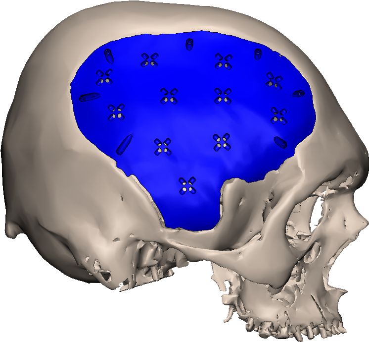 Download HD Side-psi - Cranial Prosthesis Pmma Transparent PNG Image ...