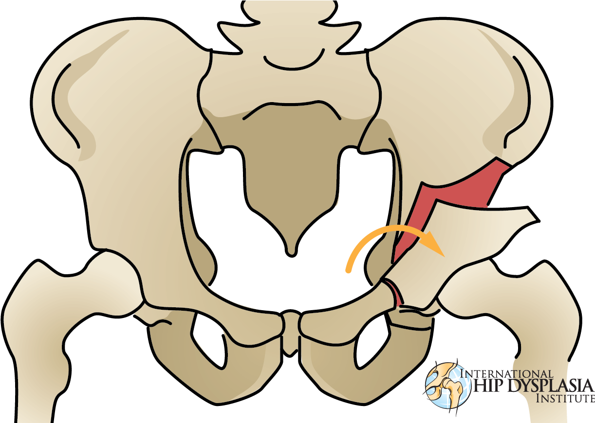 Download HD Pao2 - Periacetabular Osteotomy Transparent PNG Image ...