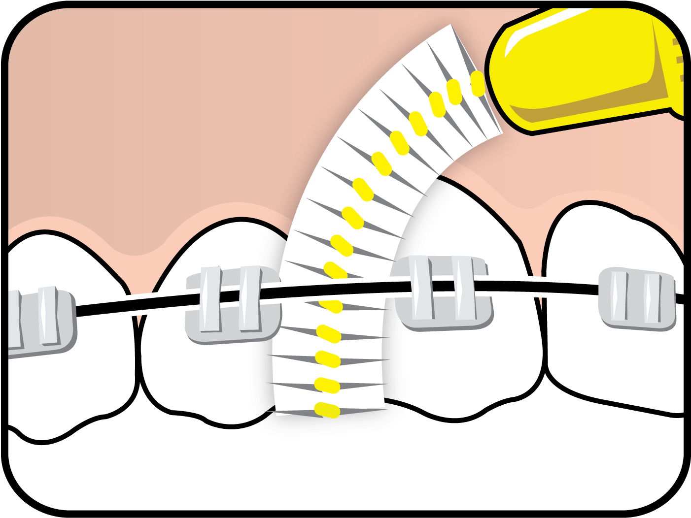Download HD Tepe Interdental Brush™ On Braces - Diagram Transparent PNG ...