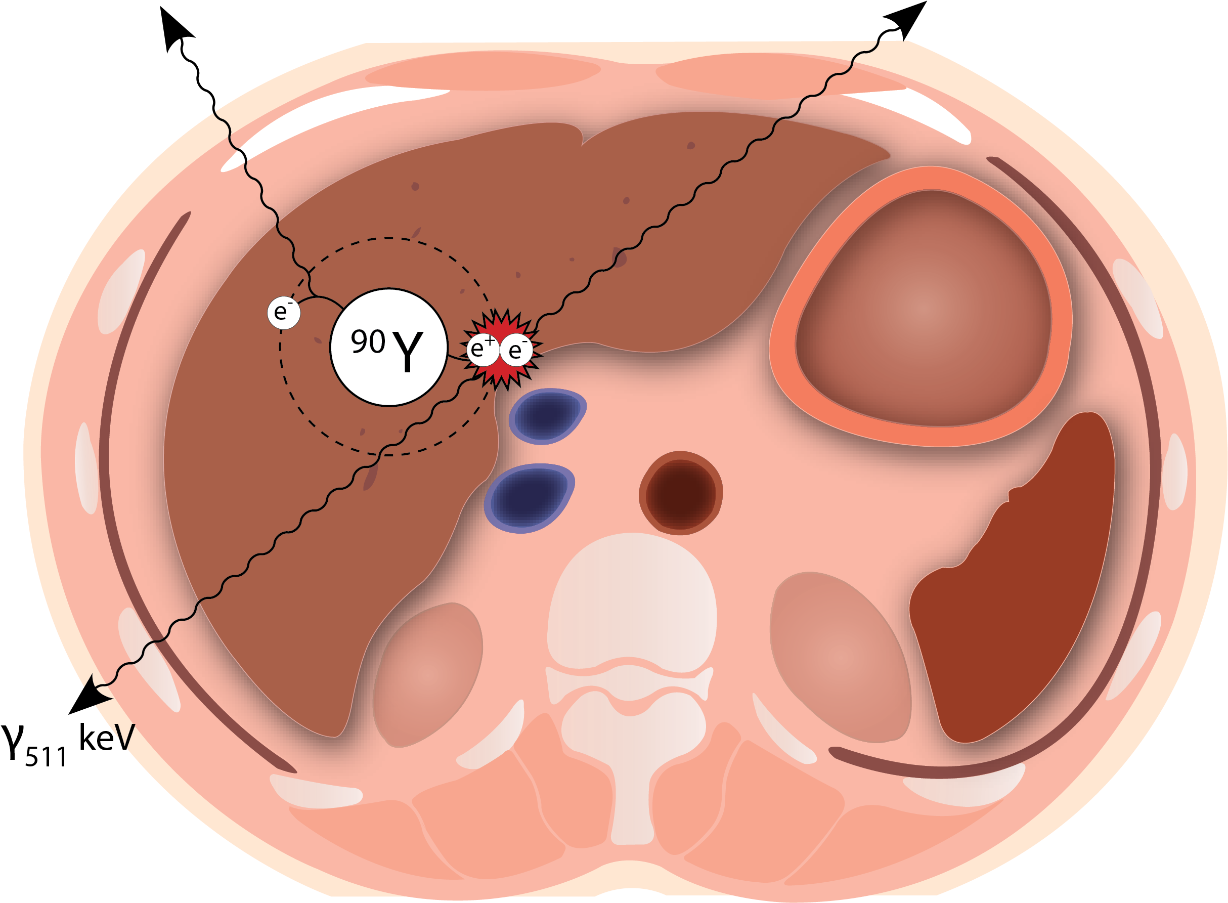 Download HD Radioembolization - Radioembolization Y90 Transparent PNG ...