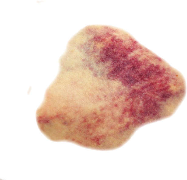 Download Bruise - Gym - HD Transparent PNG - NicePNG.com